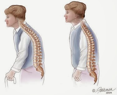 Blog Orthopaedi (Bedah Tulang): Osteoporosis - Apakah Itu?