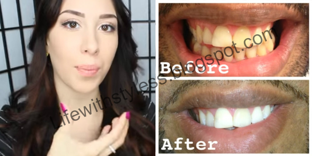 How to whiten EXTREMELY yellow teeth at home Quickly | Life With Styles