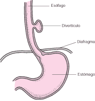 El Rincon de Medicina: Diverticulos Esofagicos