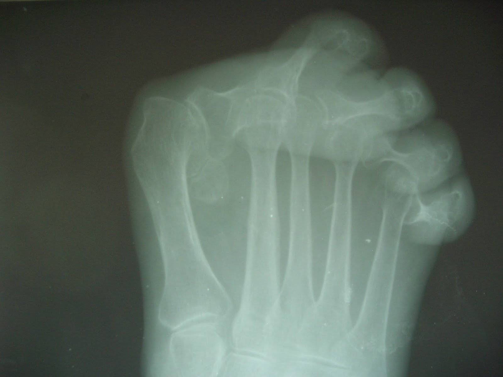 Podo Basas al Día: Cándida Glabrata. Papilomas con el K.Láser.Wright ...