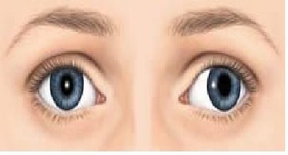 Miranza IOA: EVALUACIÓN MOTORA DEL PACIENTE ESTRÁBICO