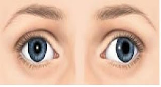 Miranza IOA: EVALUACIÓN MOTORA DEL PACIENTE ESTRÁBICO