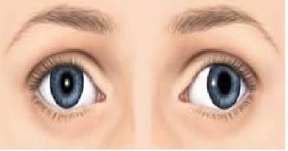 Miranza IOA: EVALUACIÓN MOTORA DEL PACIENTE ESTRÁBICO