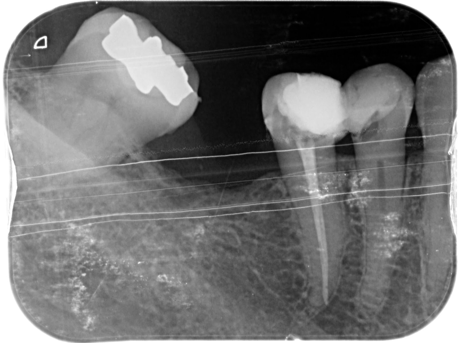 endodonciamississippi: Endodoncia #44 con entrada a cámara pulpar ...