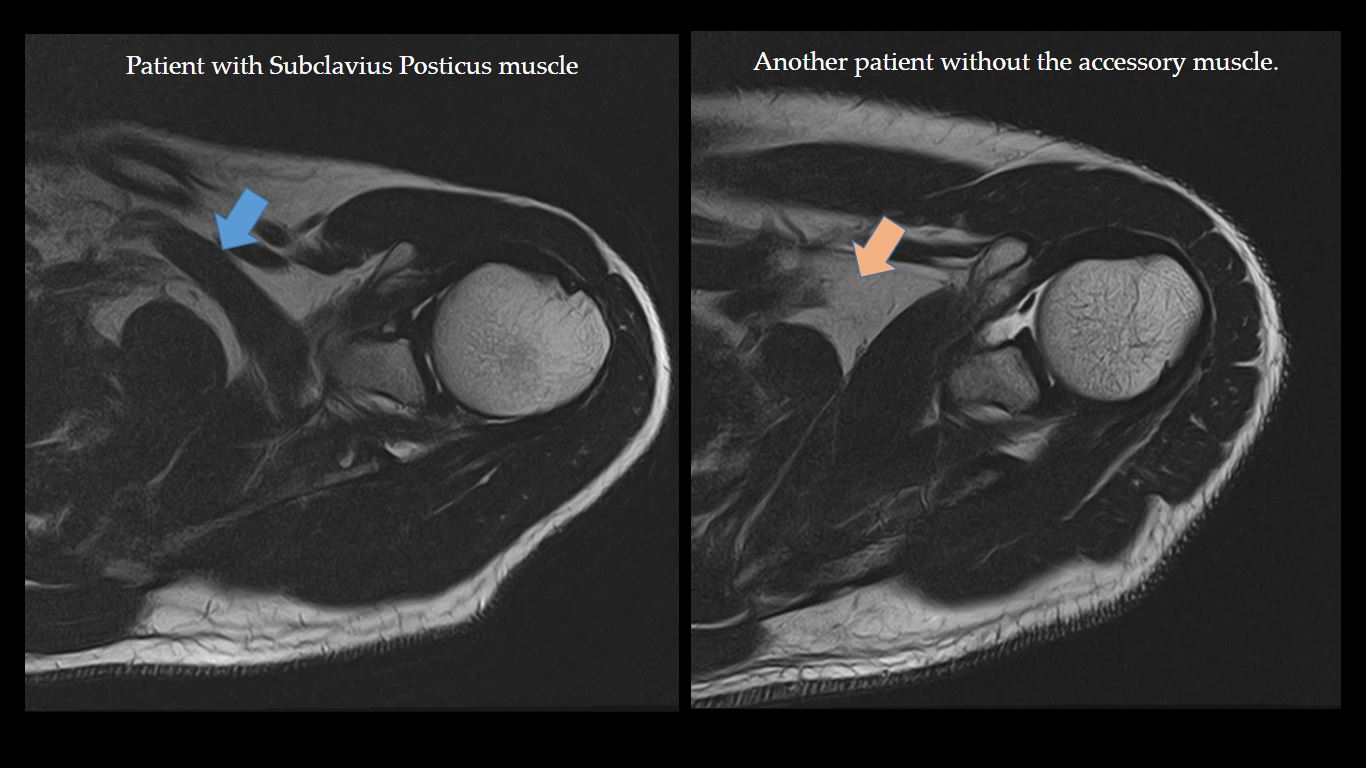 Ultimate Radiology : Subclavius Posticus ! - An accessory muscle of the ...