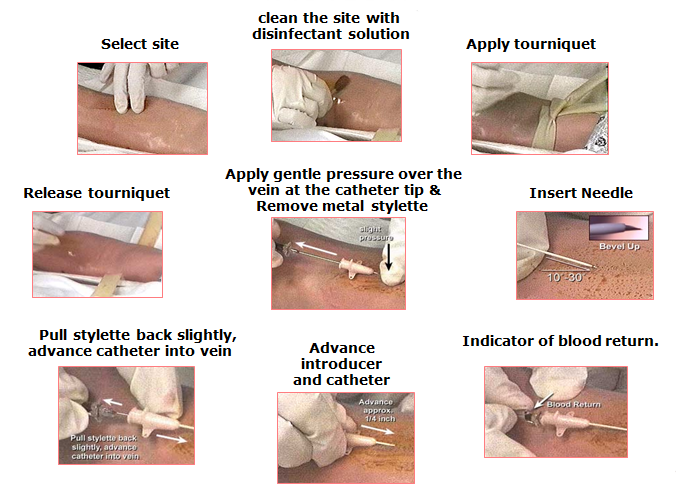 Intravenous Infusion Procedure