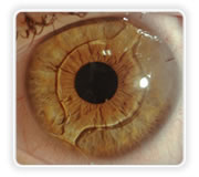 Skyvision Centers: Alcon Cachet, a New Phakic IOL