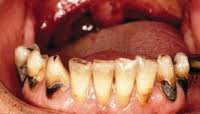 Seminario 6: Caries: Caries Radicular