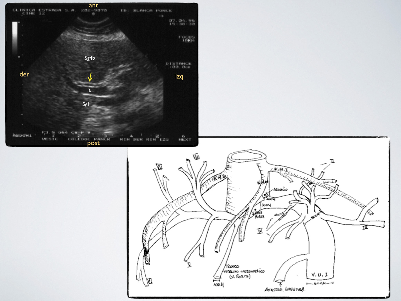 Cuadernos de Anatomía Quirúrgica: Segmentación hepática en ecografía.