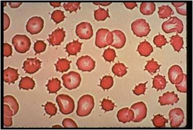 Células Sanguíneas: Acantocitos