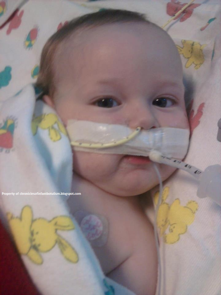 Chronicles of Infant Botulism: Baby T's Story, Chapter 13- Extubated ...