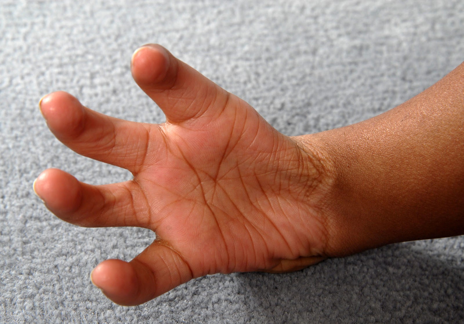 Recurrent Radial Longitudinal Deficiency | Congenital Hand and Arm ...