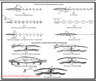 JENIS ,TEHNIK Dan PRINSIP HECTING - karya mahasiswa nurse