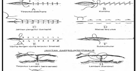 JENIS ,TEHNIK Dan PRINSIP HECTING - karya mahasiswa nurse