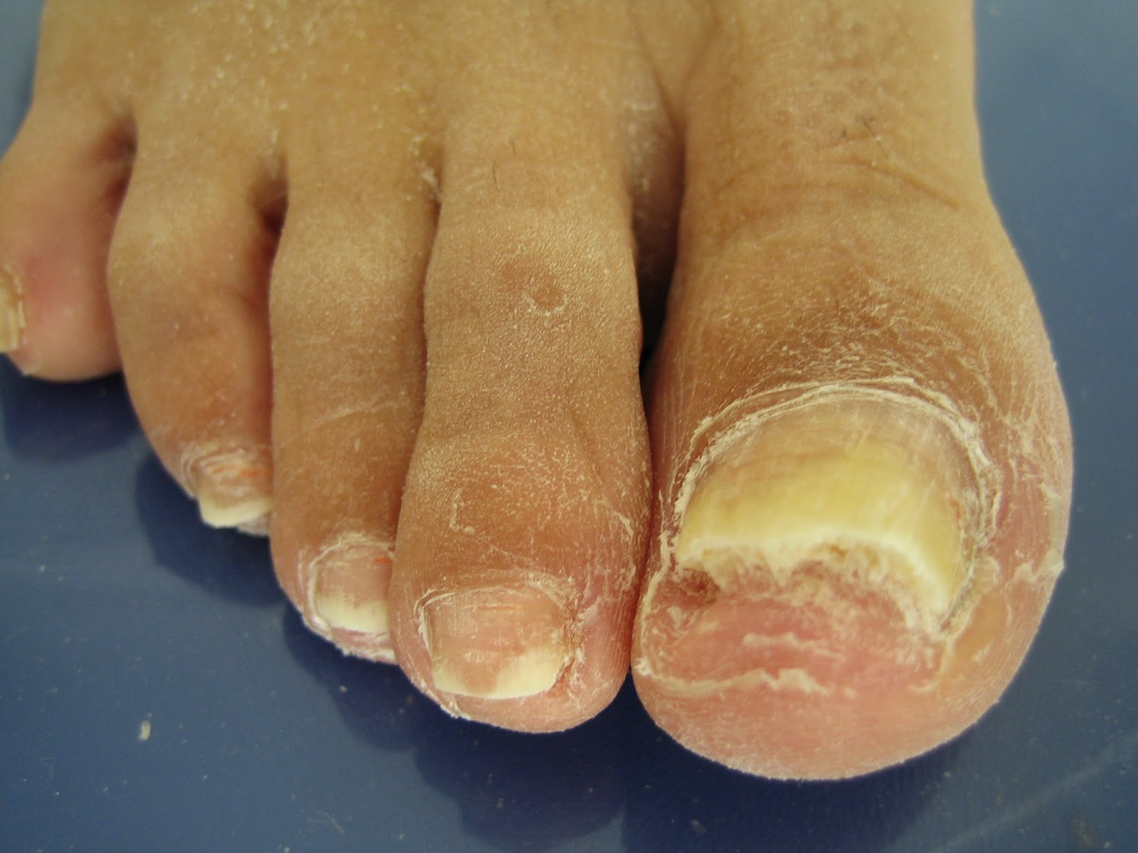 Consulta podología Zaragoza : ¿Qué es la micosis y dónde nos podemos ...