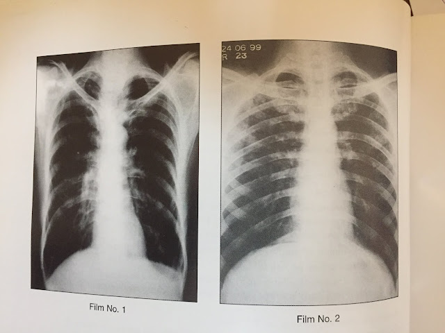 XRAYS OF EMPHYSEMA