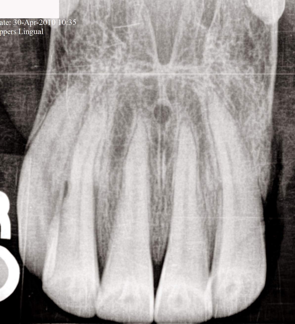 Equine Dentistry: Equine Odontoclastic Tooth Resorption and ...