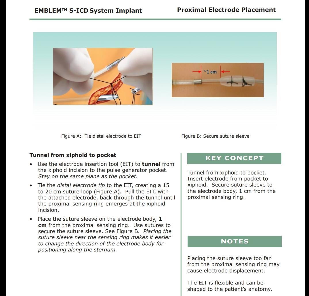 CVT Mohd Farid: Implant Management Of Subcutaneous ICD Boston Emblem SICD