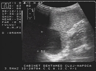 imagini splina chist hidatic tipic ecografii | Terapii naturiste si ...