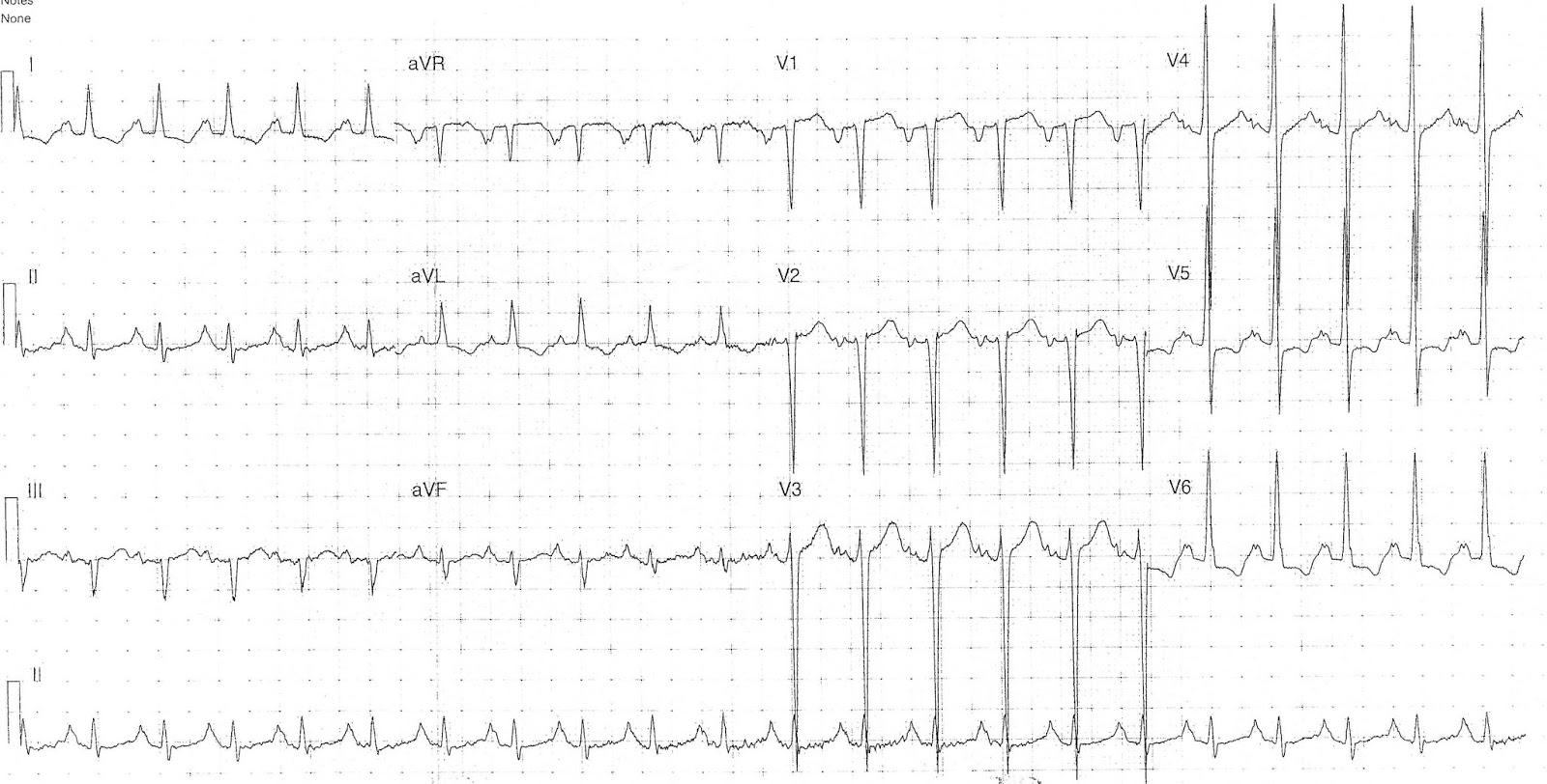 ECG of the Week: ECG of the Week - 4th September 2017 - Interpretation