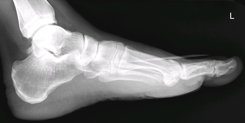 Emergence Phenomena: How to Find Foreign Bodies