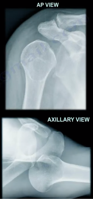 Dr. Nabil Ebraheim's Blogspot: Shoulder Dislocation, Posterior