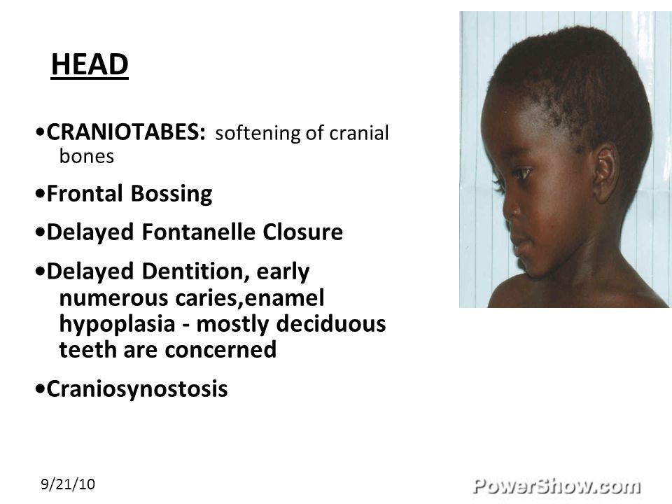 craniotabes - USA News Collections