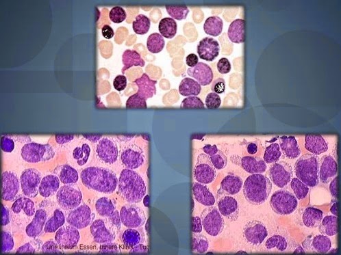 Atlas de hematologia: Leucemia indiferenciada M0