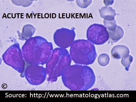 Lab Atlas: Acute Myeloid Leukemia