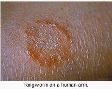 All About Living With Life: Ringworm, Calamine and Clotrimazole