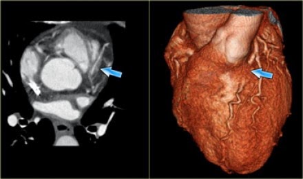 A Myocardial Bridge Journey: Myocardial Bridge 101