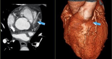 A Myocardial Bridge Journey: Myocardial Bridge 101
