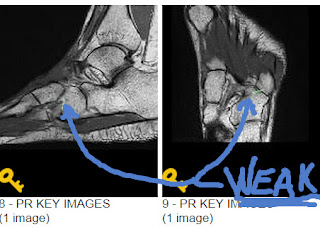 Two Little Runners: Cuboid Stress Fracture