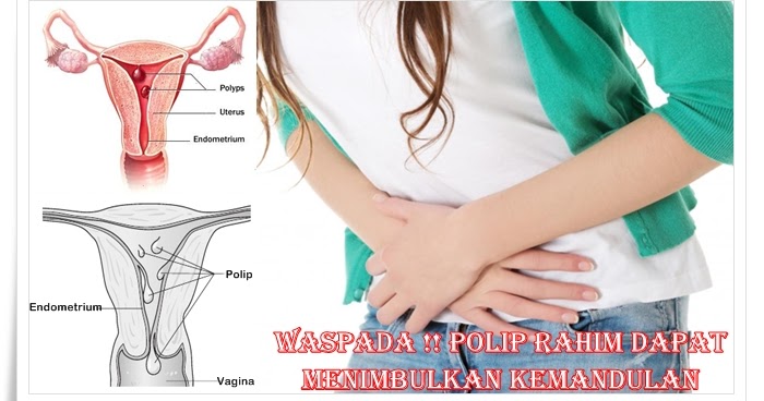 Pengobatan Herbal Polip Rahim Secara Alami ~ Gejala Pantangan dan Penyebab