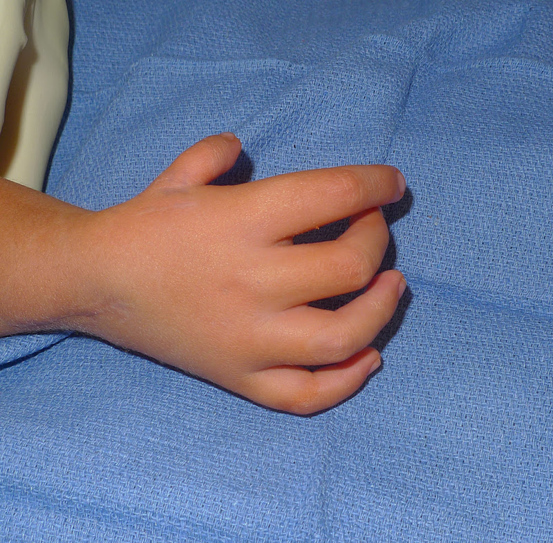 More thoughts on Pollicization | Congenital Hand and Arm Differences ...