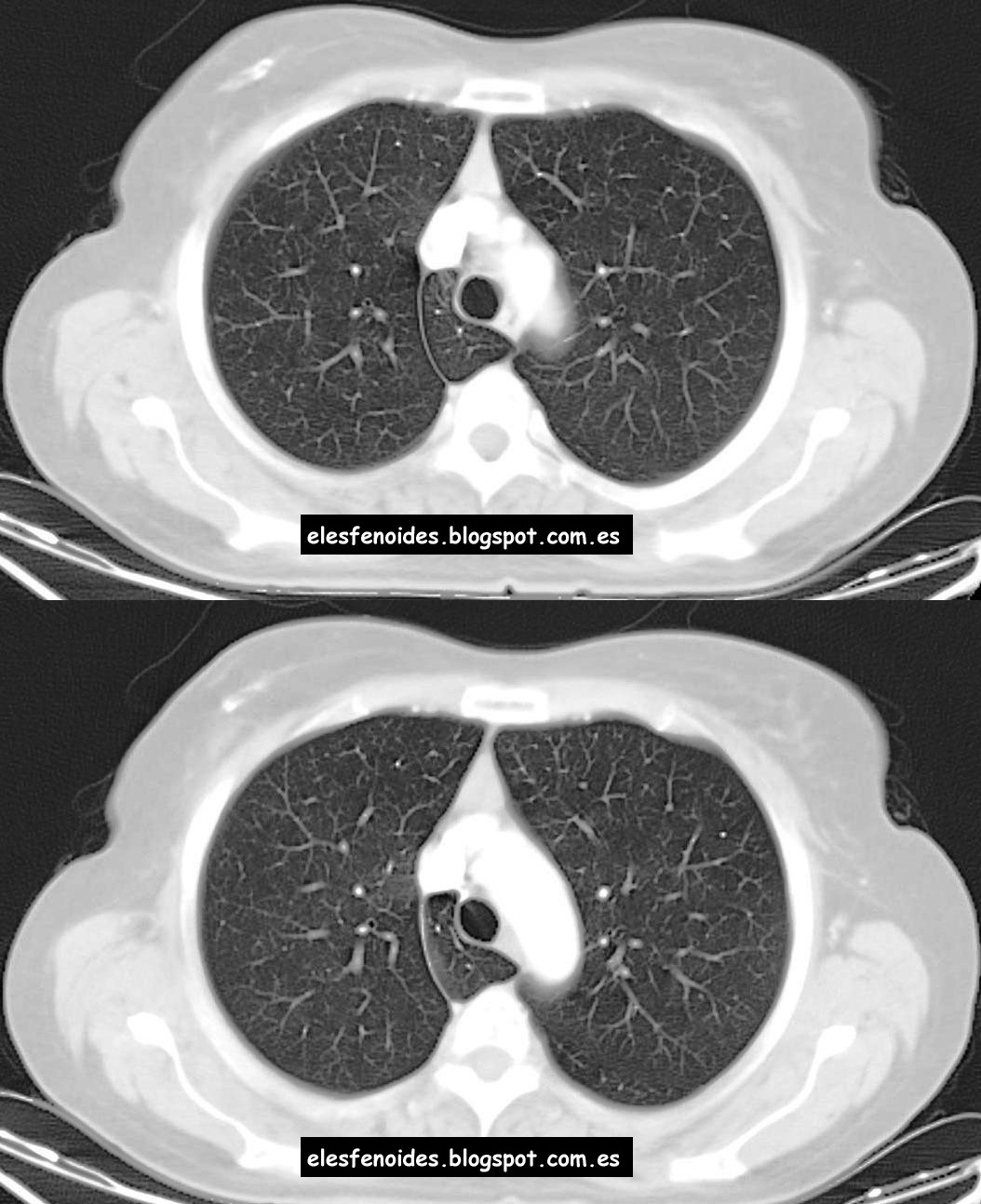 El esfenoides: Cisura y lóbulo accesorio de la ácigos. 2 imágenes 1 caso.