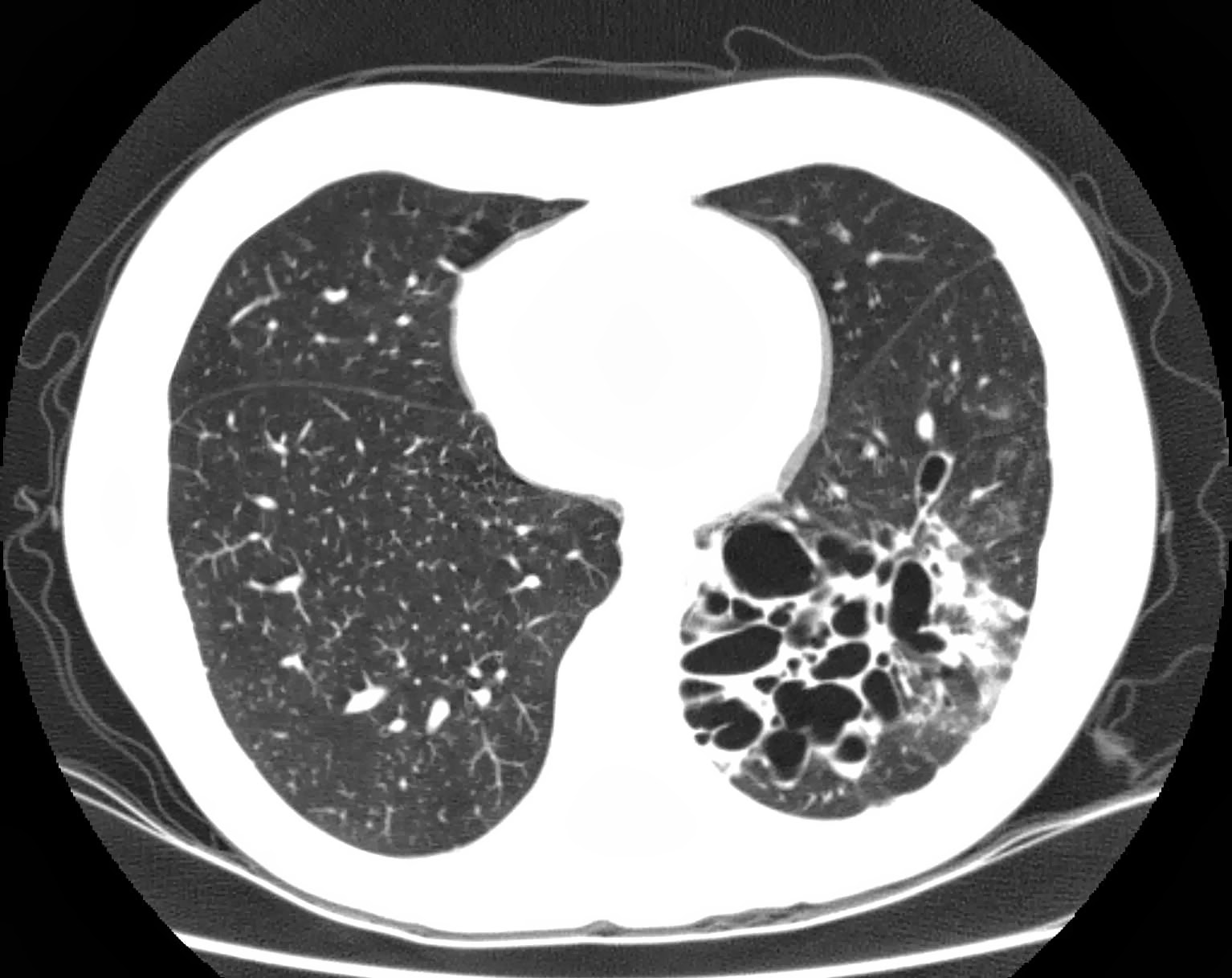 PATOLOGIA: PATOLOGÍA PULMONAR (ENFERMEDAD PULMONAR OBSTRUCTIVA CRÓNICA)