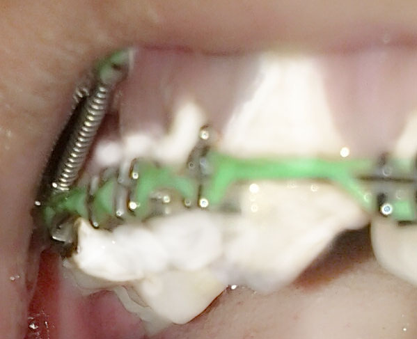 Mr Braces 7Eleven: Appt Tukar Getah Braces - Green String (Power Chain)