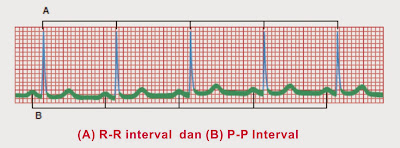 Interval Pada EKG