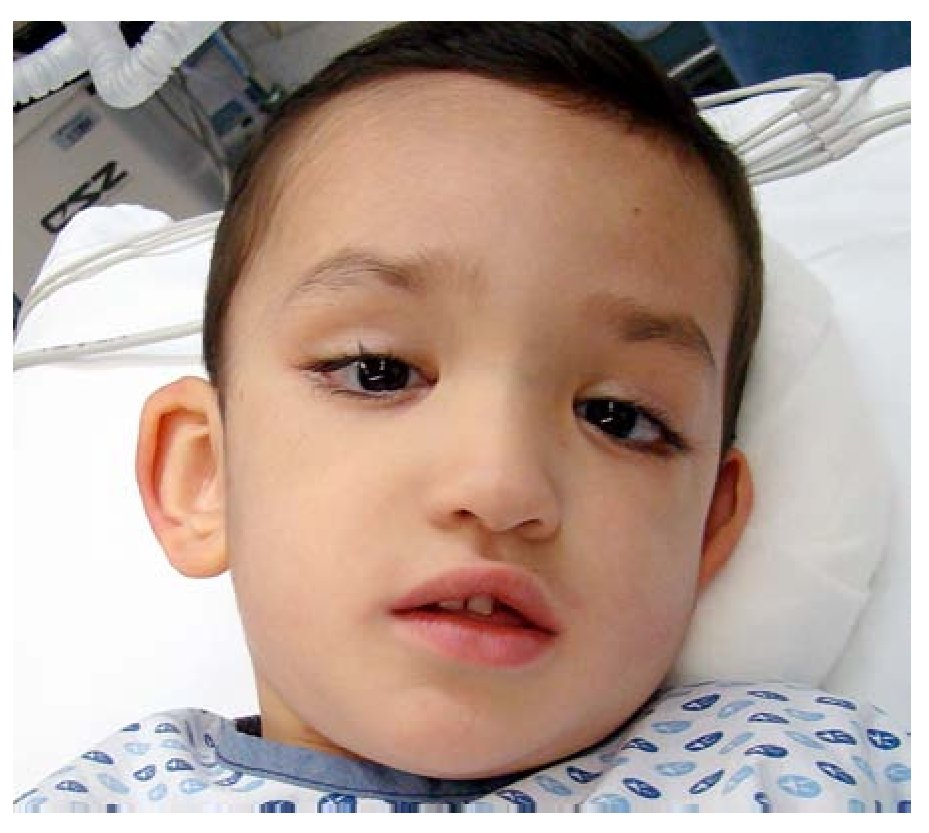 Aprendiendo biología : SINDROMES: MONOSOMIA