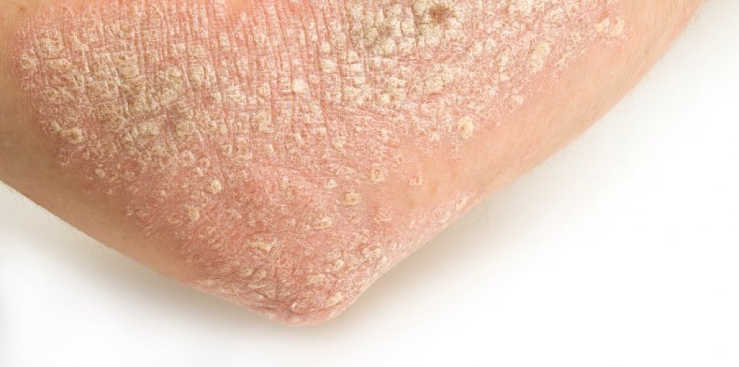 Alivio para la psoriasis en codos: consejos y tratamientos efectivos