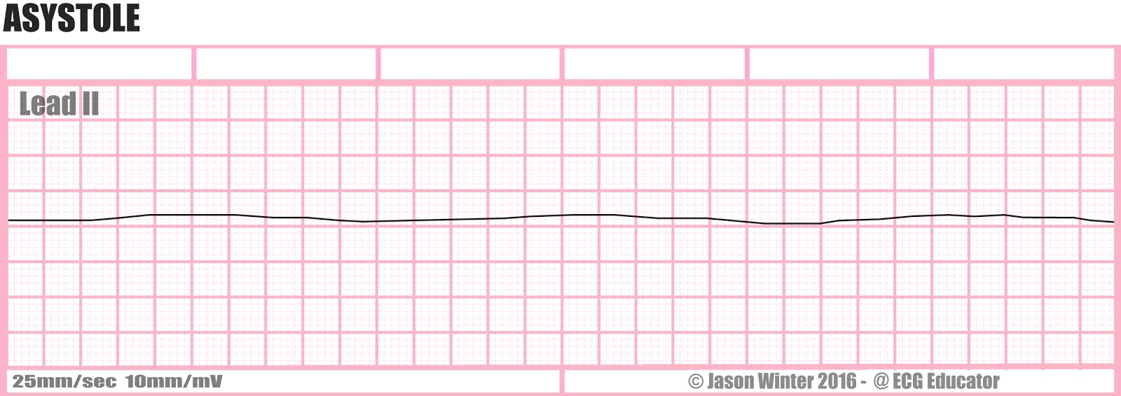 ECG Educator Blog : Six Second ECG Rhythm Strips