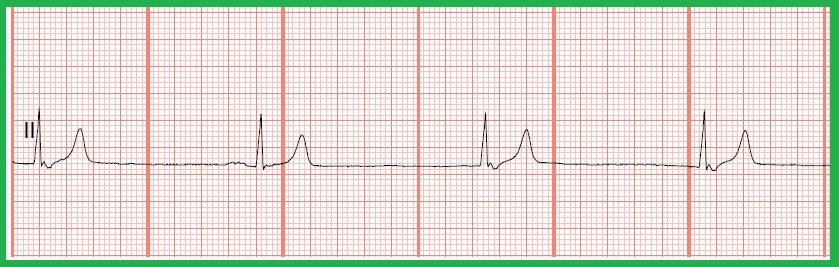 Characteristics of Junctional Rhythms