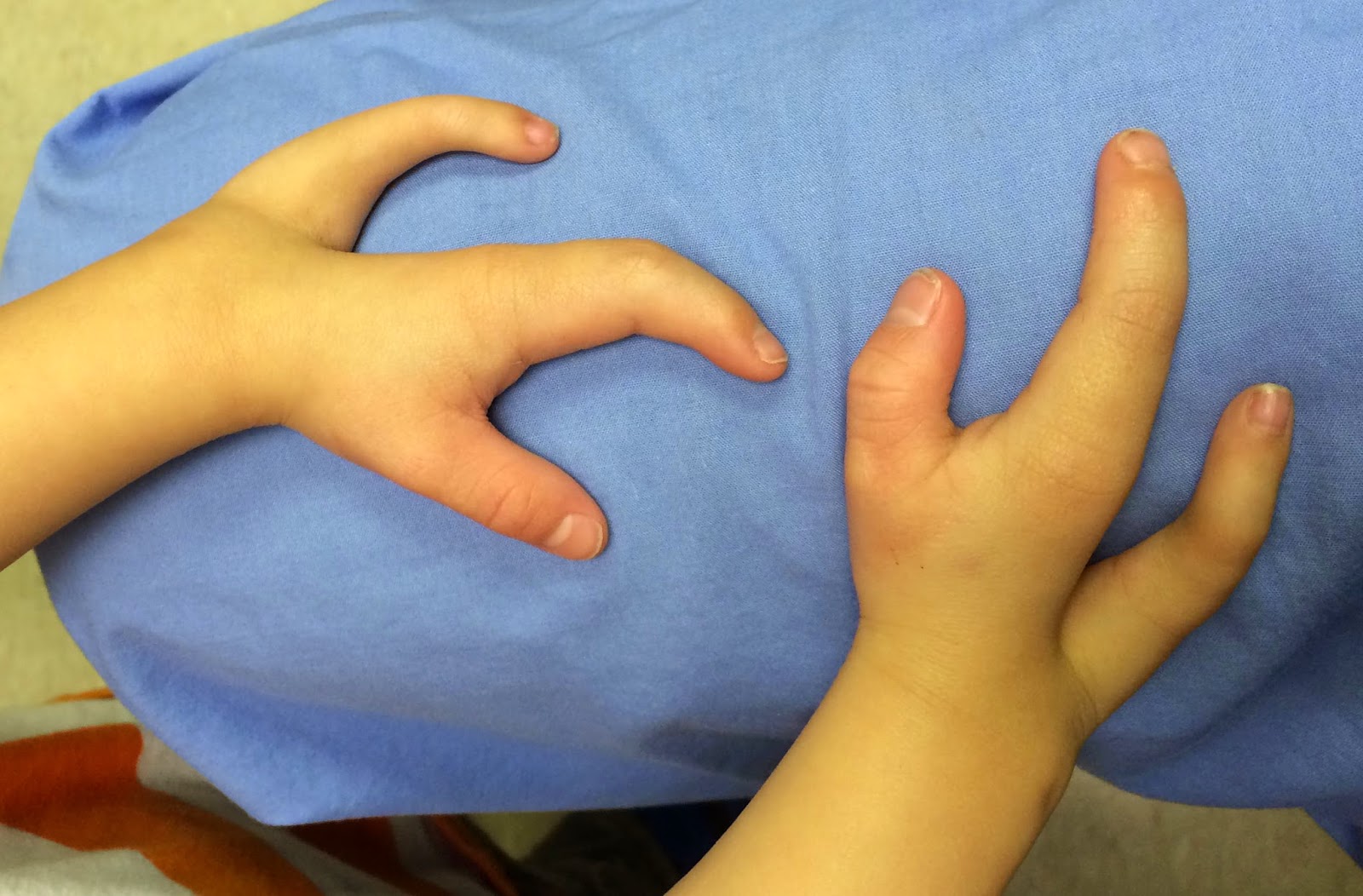 Ulnar Sided Cleft Hand | Congenital Hand and Arm Differences ...