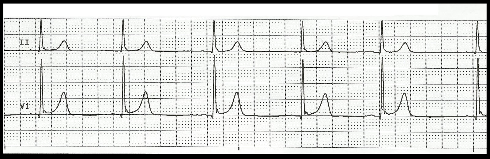 Practice EKG Rhythm Strips 163