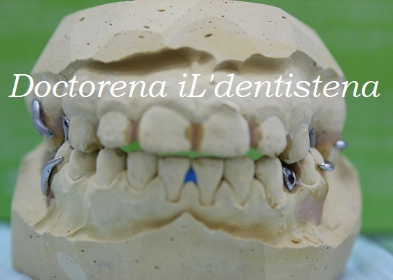 My Dental Diary: CO-Cr. RPD