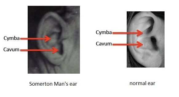 SOMERTON MAN: THE EAR COMPARISON, DETAILED IMAGE. YOU DECIDE ...