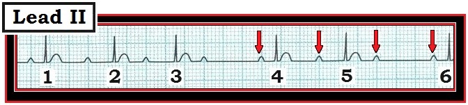 ECG Interpretation: ECG Interpretation Review #66 (2nd Degree AV Block ...