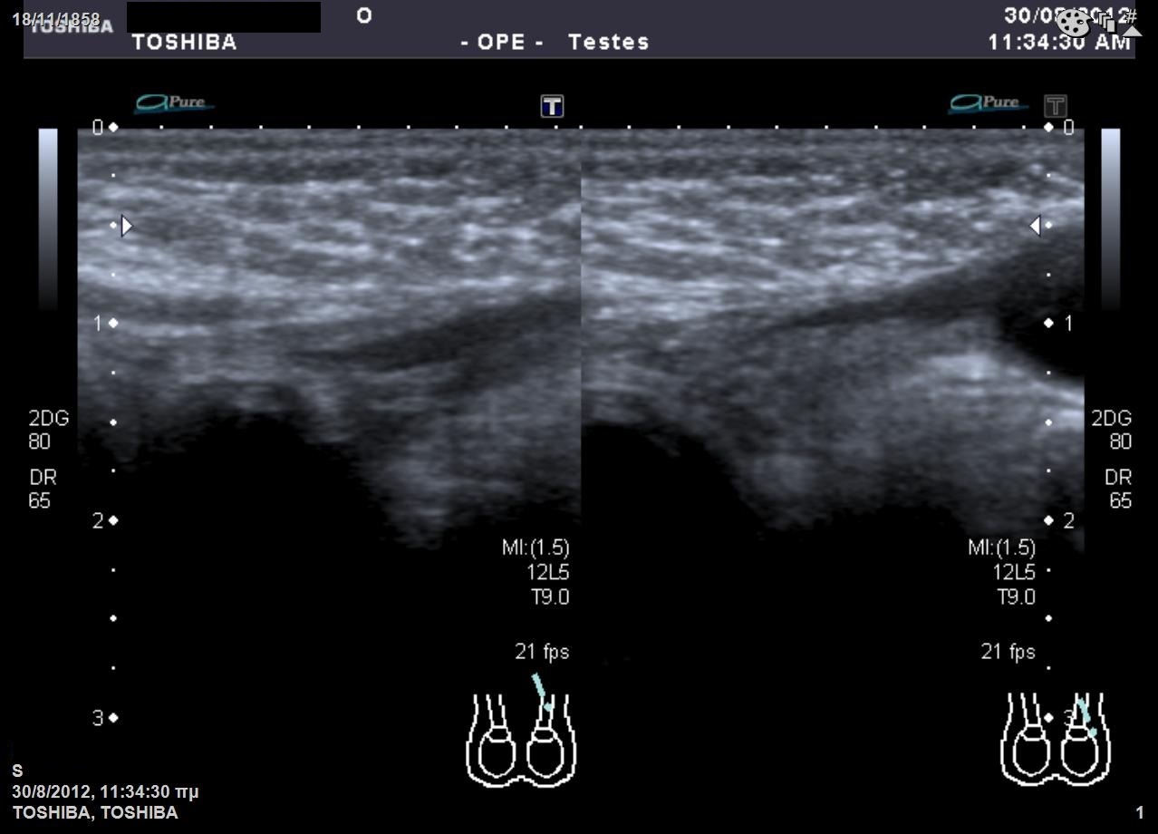 Spermatic Cord Hydrocele Usg Sumers Radiology Blog