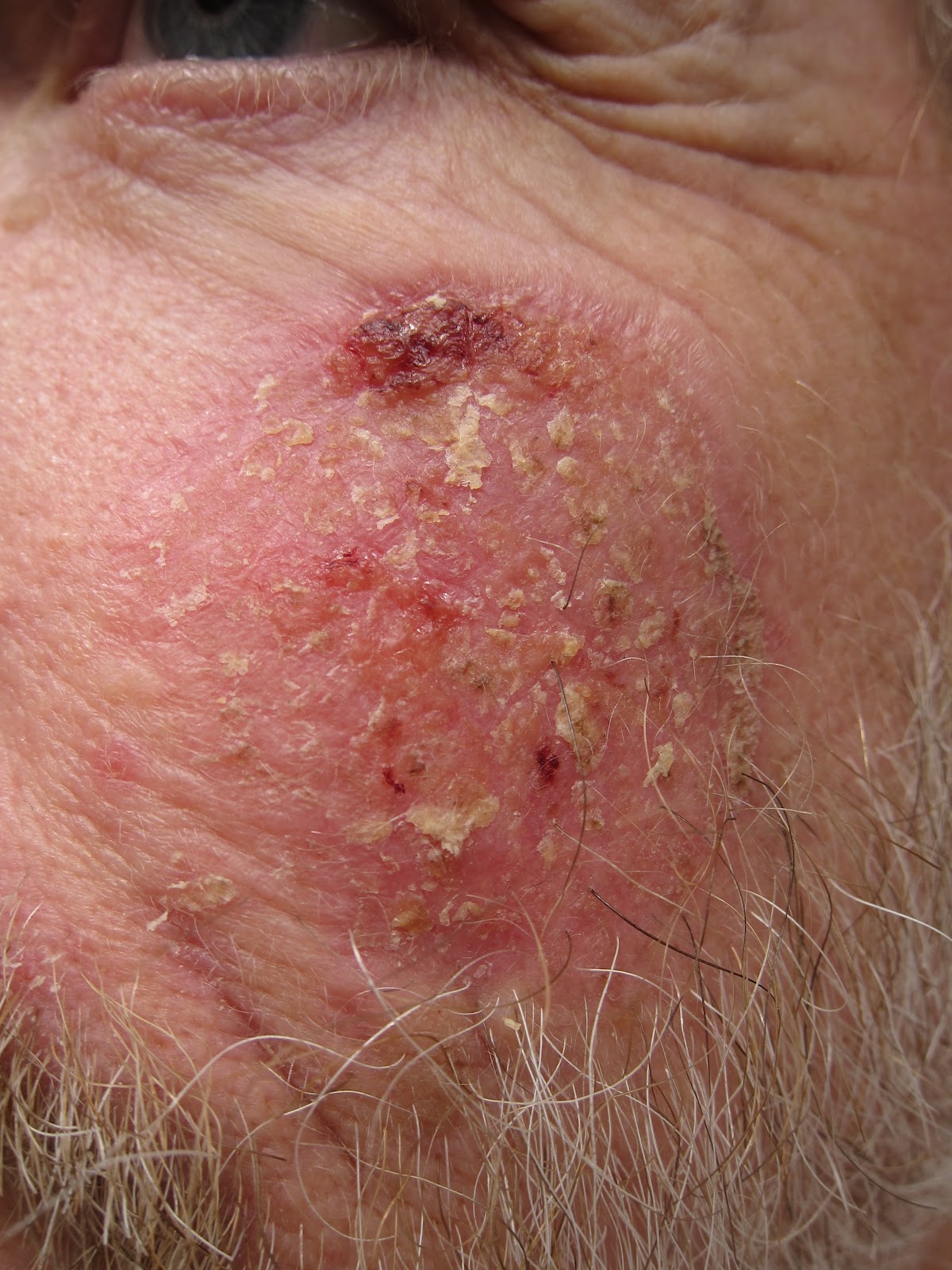 Efudex - Round Two: Four weeks and done